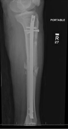 Proximal Third Tibia Fracture - Trauma - Orthobullets